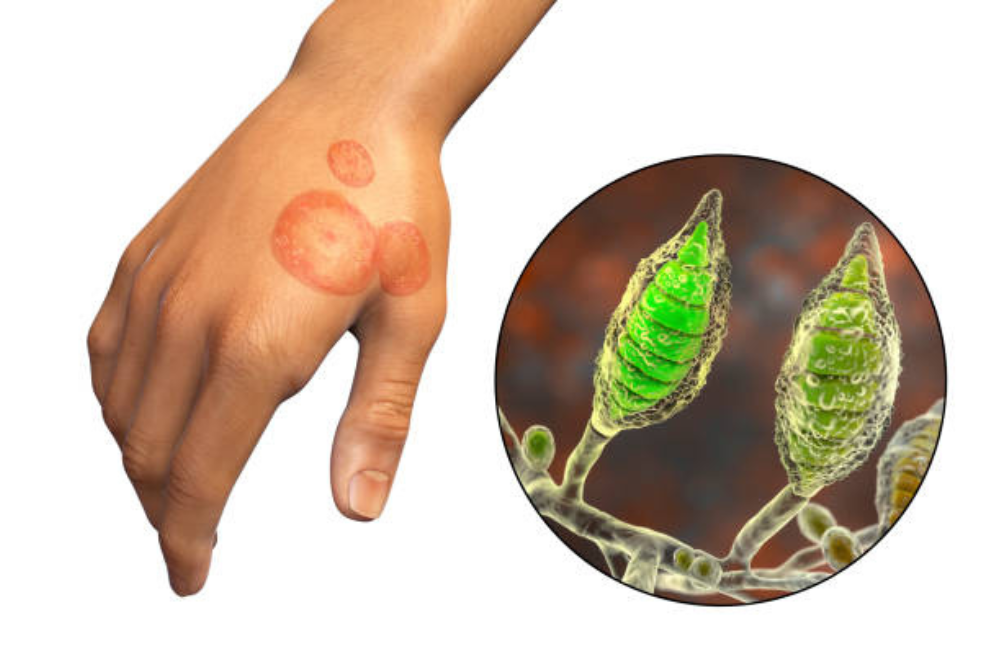 Skin Disease - Tathagatha Ayurveda
